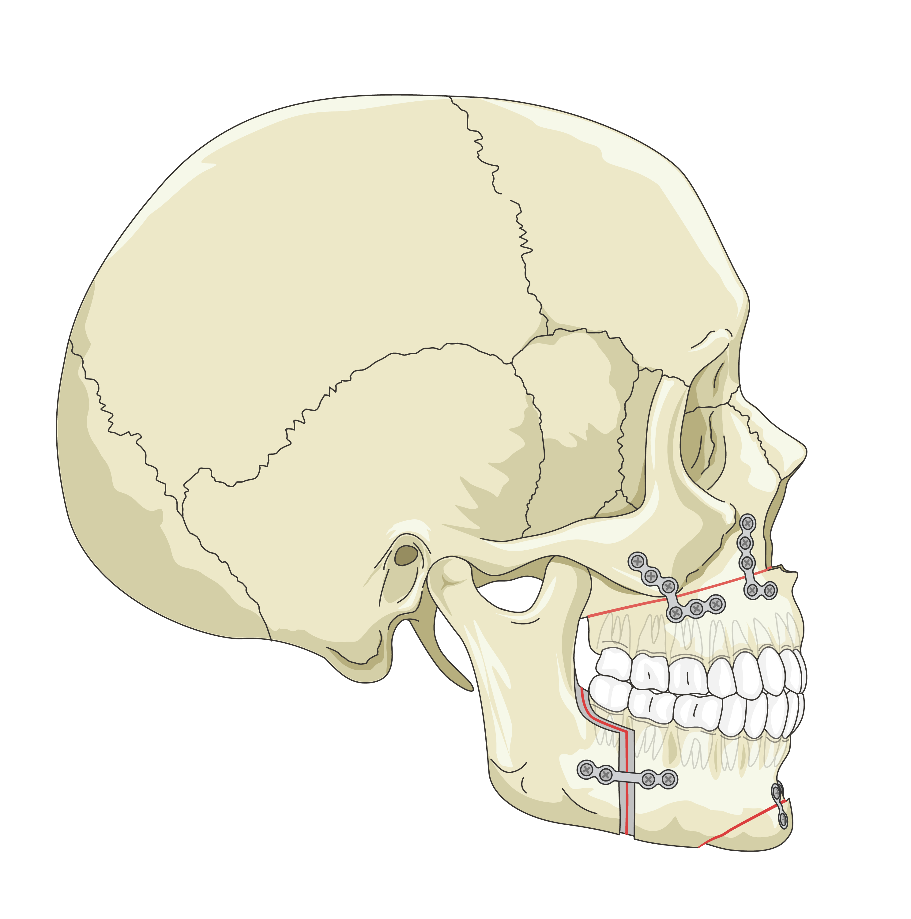 Orthognathic Jaw Surgery | Maxillo-Facial Surgery Institute Irvine