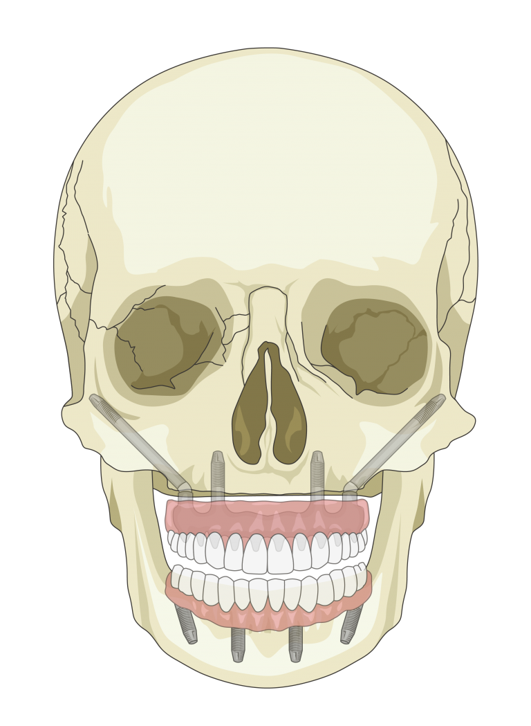 Dental Implants | Maxillo-Facial Surgery Institute Irvine