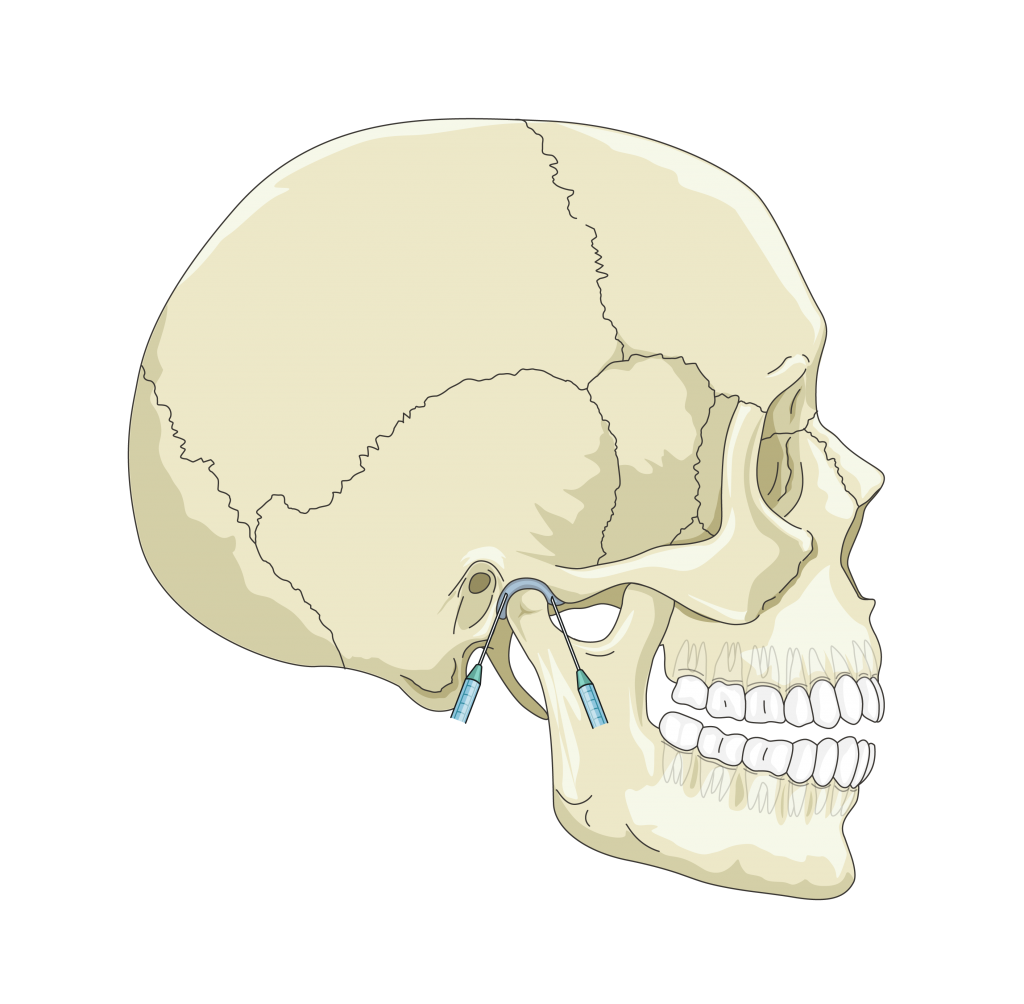 TMJ Arthrocentesis in Irvine, CA | Maxillo-Facial Surgery Institute Irvine